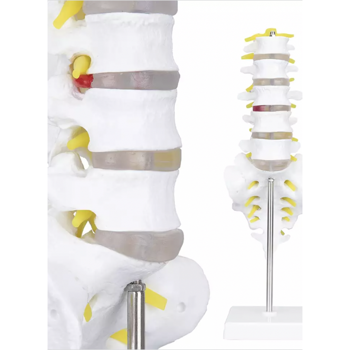 Lumbar Vertebrae. With Sacrum & Coccyx And Herniated Disc (Life-Size)