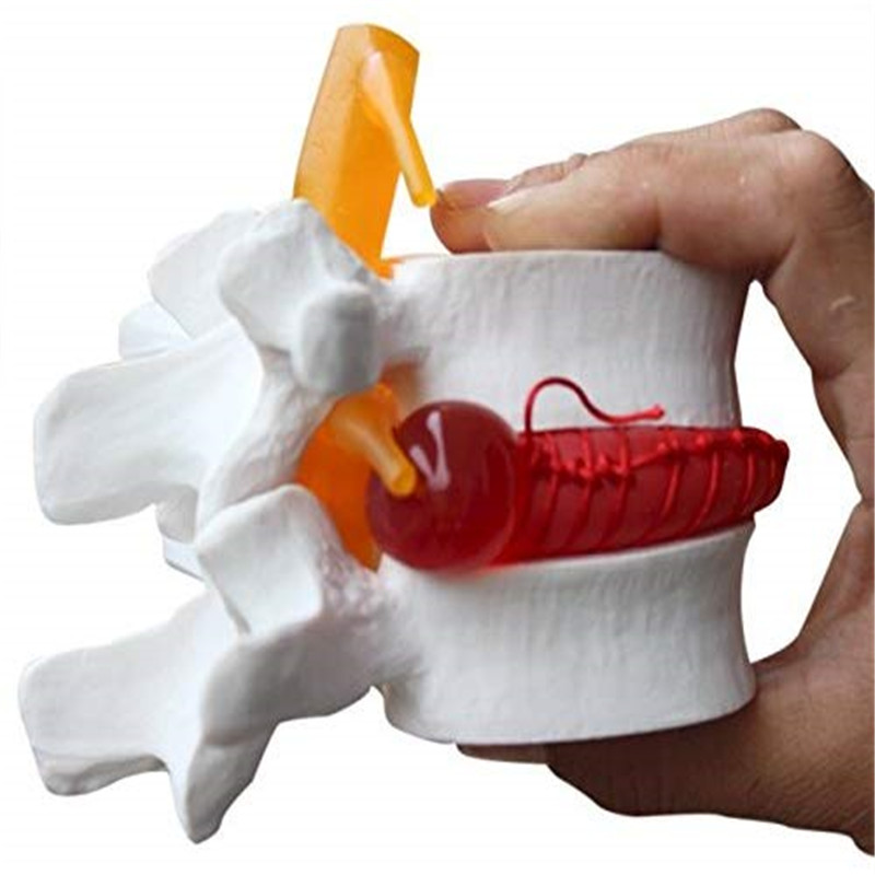 lumbar spine herniated disc prolapse model